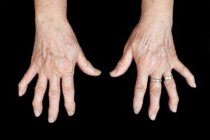 Myalgia and Myositis: Know about Muscle Pain and Inflammation