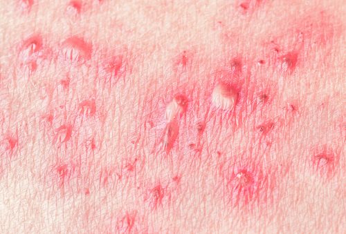 Natural remedies for shingles, Causes and symptoms of shingles