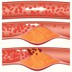 Atherosclerosis Plaque Rupture, Heart Attack and Stroke Risk Detecting ...