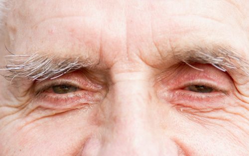 Common eye problems and diseases in aging adults