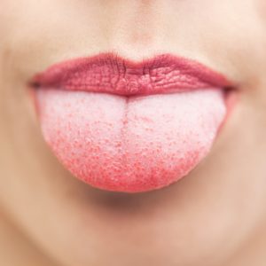 White tongue causes, symptoms, and home remedies