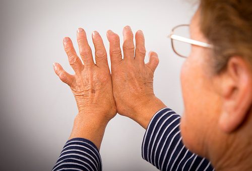 Managing Rheumatoid Arthritis Flare-ups through treatment