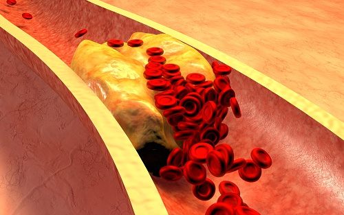 Atherosclerosis: Causes, symptoms, treatment, and lifestyle changes