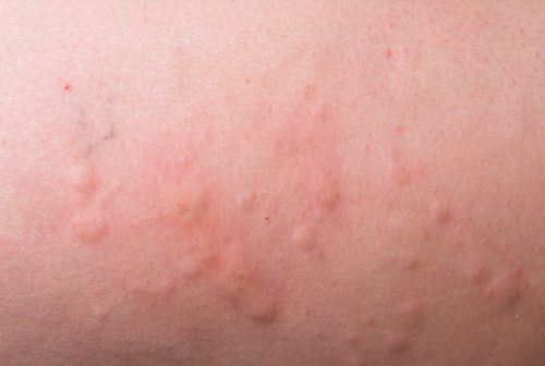 Connection between chronic spontaneous urticaria (CSU) and parasite ...