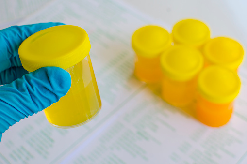 Proteinuria (Protein in urine) treatment with statins and home remedies