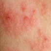 Pityriasis Rosea Stages, Symptoms and Complications