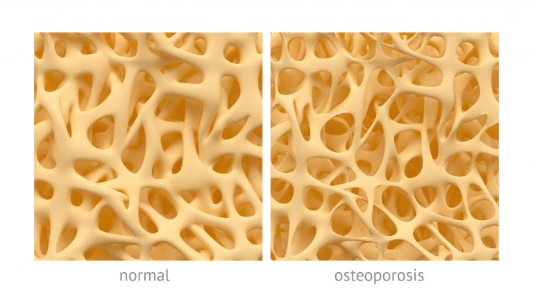Psoriasis or psoriatic arthritis patients show higher osteoporosis and ...