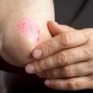 Psoriasis vs. ringworm, differences in symptoms, causes, and treatments