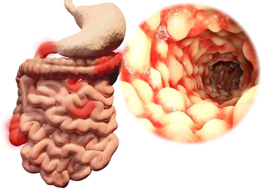 Crohn’s disease, ulcerative colitis progression and development linked ...