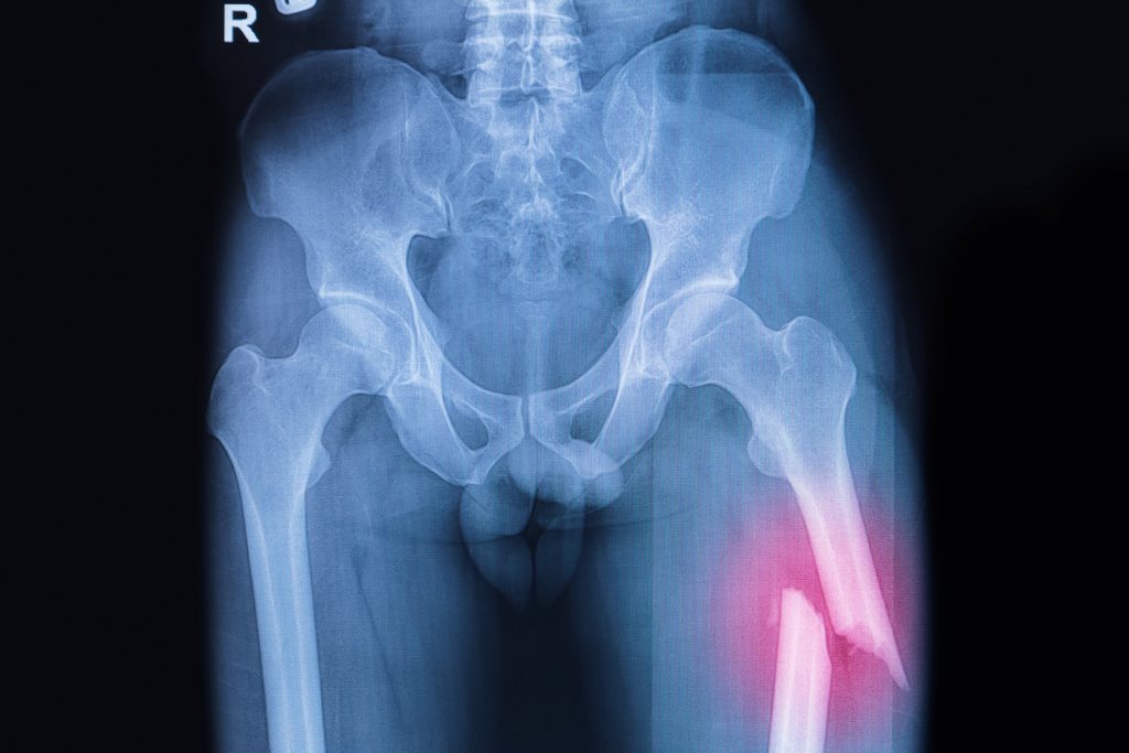 Osteoporosis medications can cause small risk of thigh bone fractures ...