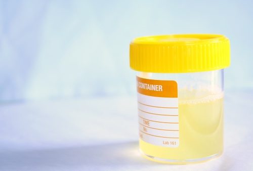 Common Causes of Cloudy Urine & Treatment Tips - Bel Marra Health