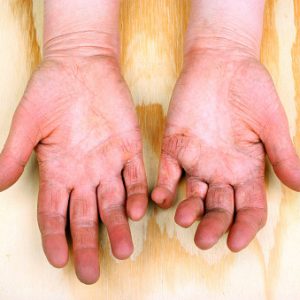 Arthralgia vs. Arthritis Joint Pain: Know the Difference