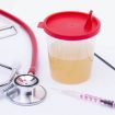 Mucus in Urine: Types, Common Causes & Treatment Options