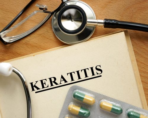 Keratitis (inflammation of the cornea) causes, symptoms, and treatment