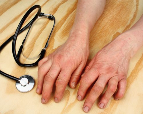 New biologic drug for rheumatoid arthritis approved by the FDA