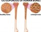 Simple Strategies to Manage Diabetes Related Bone Problems