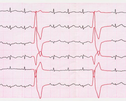 Heart arrhythmia: Diagnosis, tests, and treatment options