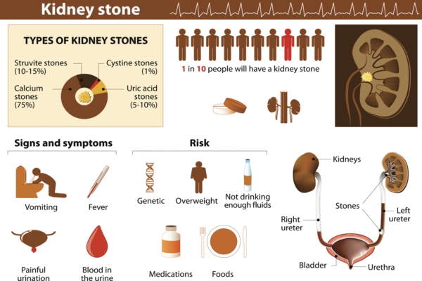 Enlarged prostate treatment may help passage of large kidney stones in ...
