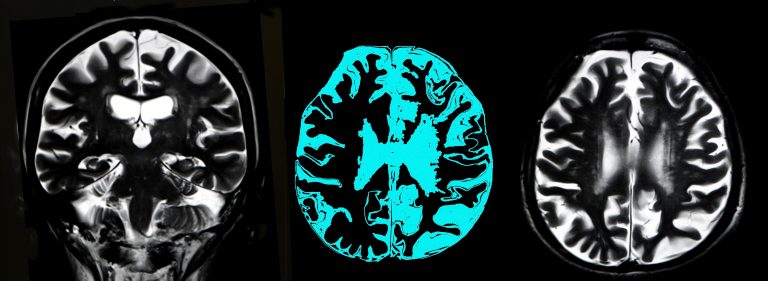 In type 2 diabetes, cognitive decline is linked to brain atrophy ...