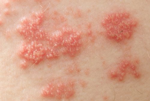 What is shingles and why you may be at risk