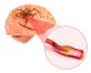 Types of cerebral ischemia: Symptoms, prevention, and treatment tips