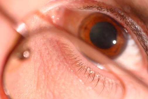 Mydriasis: What causes your pupils to dilate and how to treat?