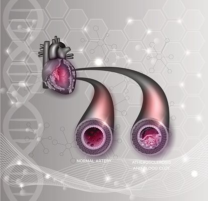 Restenosis: Causes, treatment, and prevention