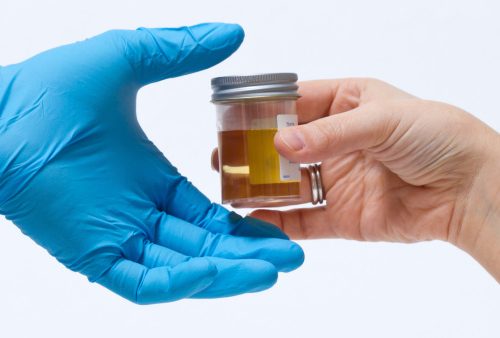 What is sediment in urine? Causes, symptoms, and treatment