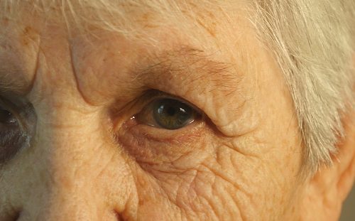 What eye freckles reveal about your health
