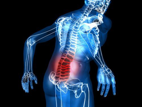 Lumbar Radiculitis: Symptoms, Causes, Diagnosis and Treatments