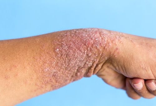 Eczema can increase the risk of cardiovascular diseases