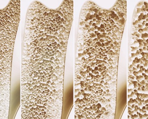 This One Thing Can Help Reduce Bone Loss