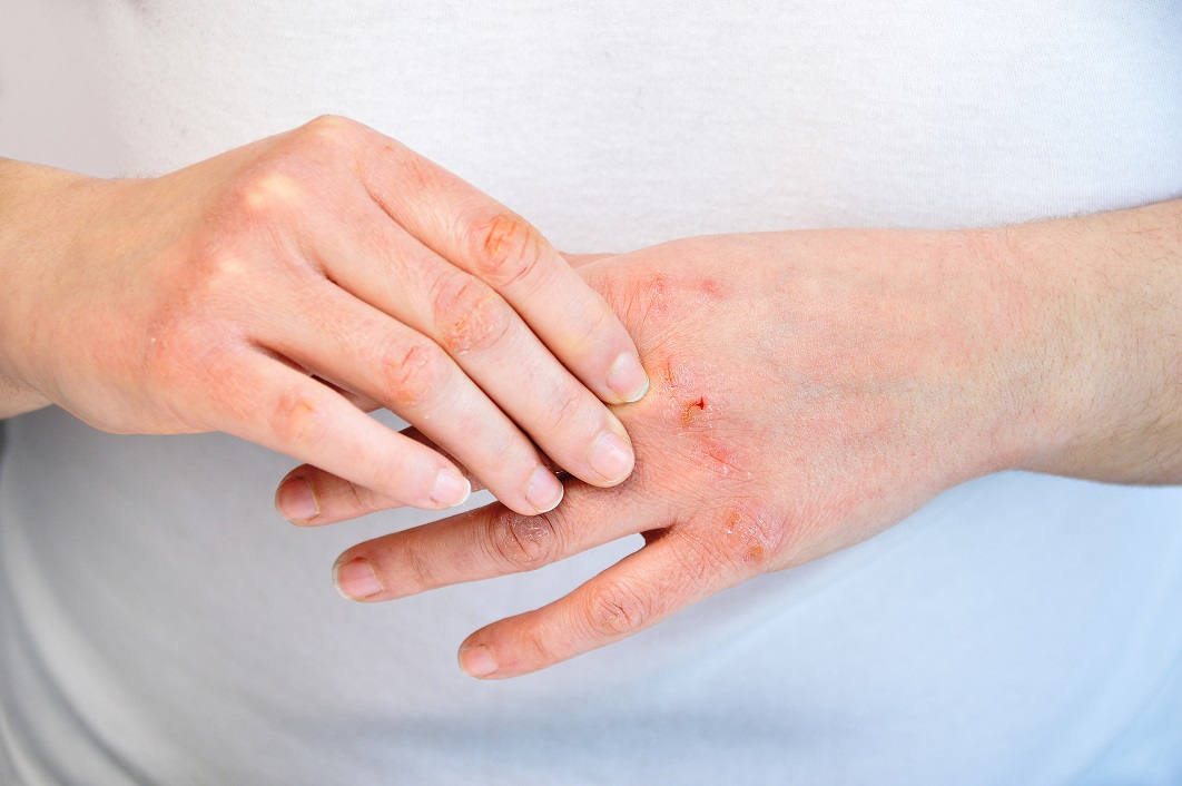 Are Your Dry Hands Really Eczema?