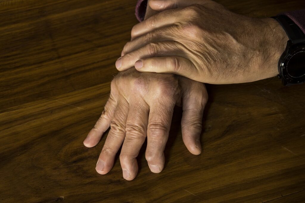 Figuring Out Arthritis in Your Hands